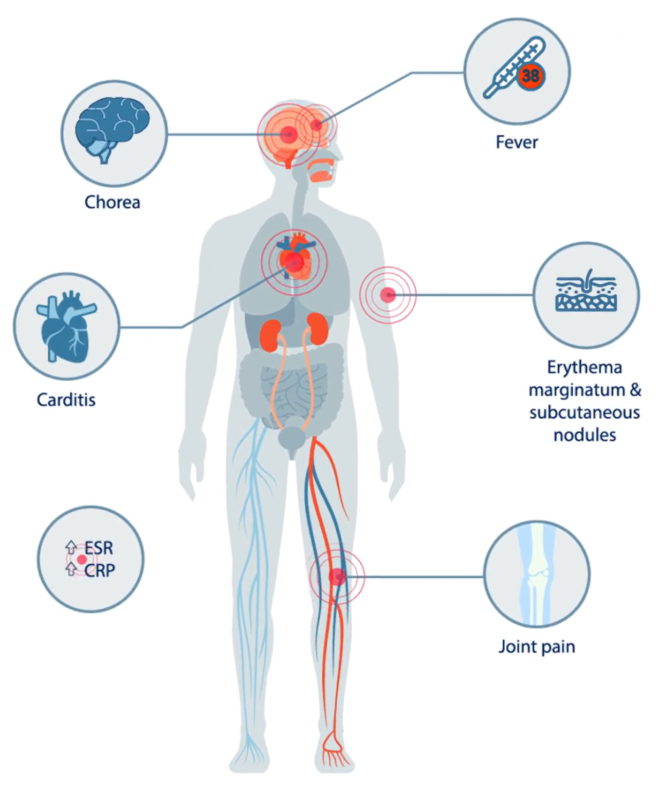 ARF for Emergency Departments - RHD Menzies